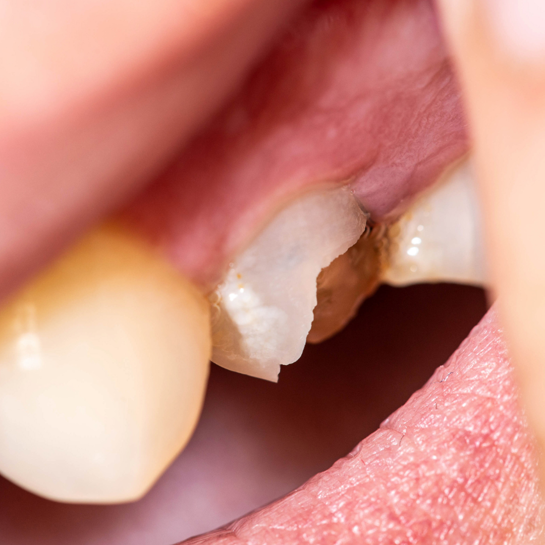 Chipped Tooth Katy: 1 Best Repair and Restoration